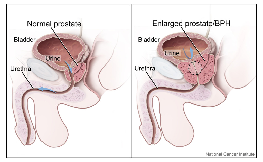 Prostate Health Cancer And Enlarged Gland Information